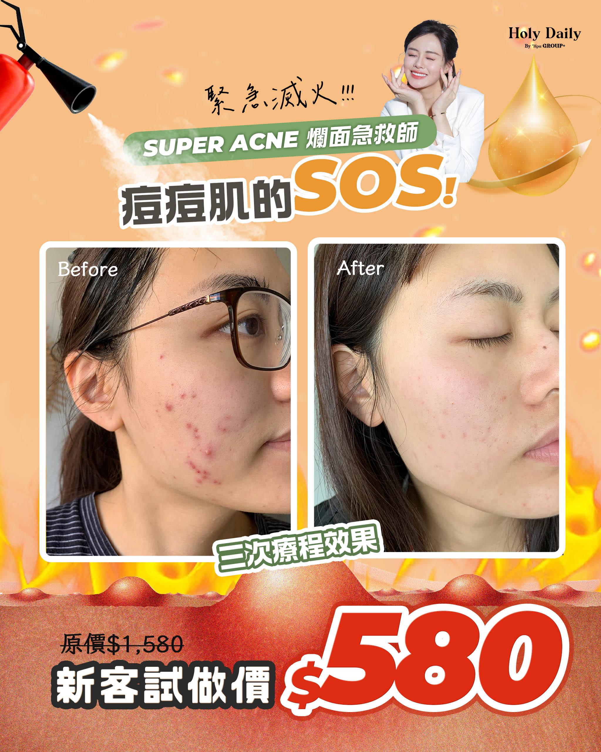\ 新客限定 /SUPER ACNE 爛面急救師 – Holy Daily